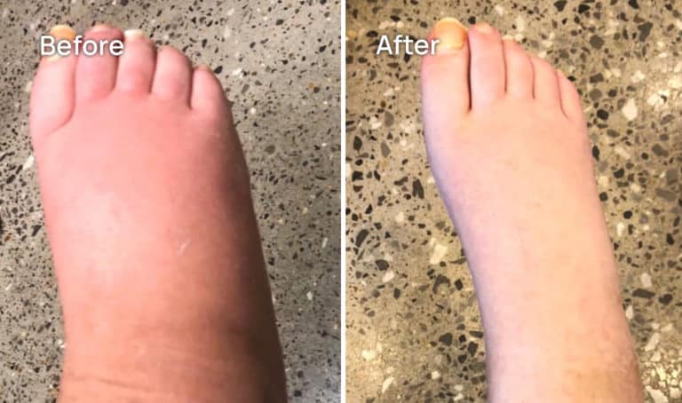 The Suicide Disease CRPS | Complex Regional Pain Syndrome