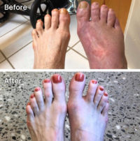 Treatment for CRPS in Foot/Ankle - Severe Chronic Pain - Spero Clinic