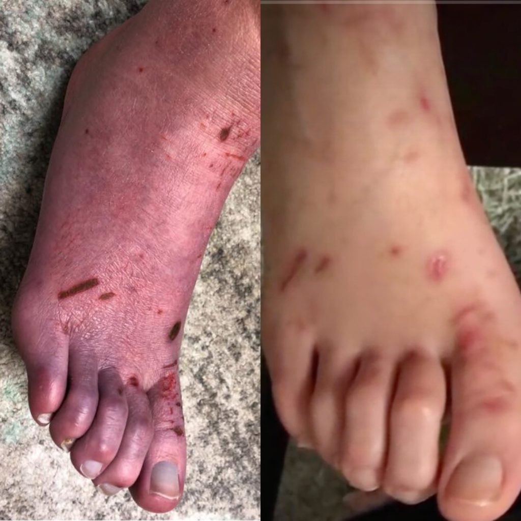 Treatment for CRPS in Foot/Ankle - Severe Chronic Pain - Spero Clinic