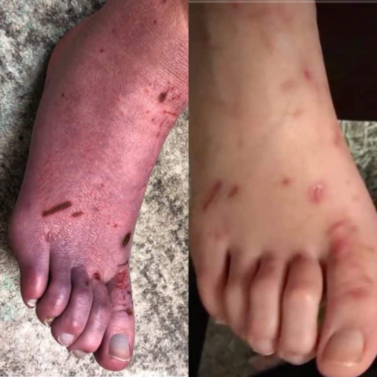 Treatment for CRPS in Foot/Ankle - Severe Chronic Pain - Spero Clinic